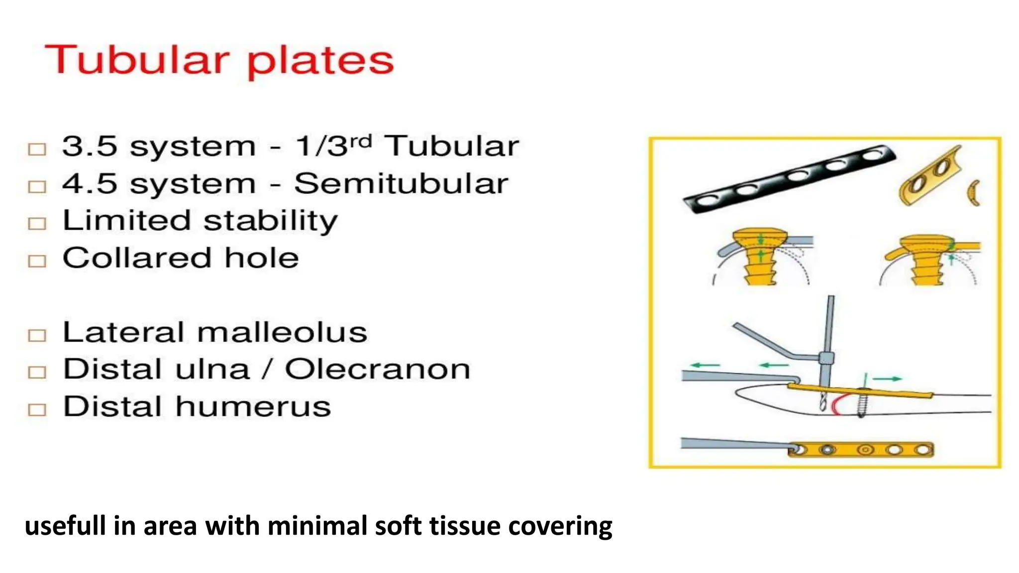 BONE PLATING USES AND COMPLICATION ORTHOPAEDICS PPT | PPTX