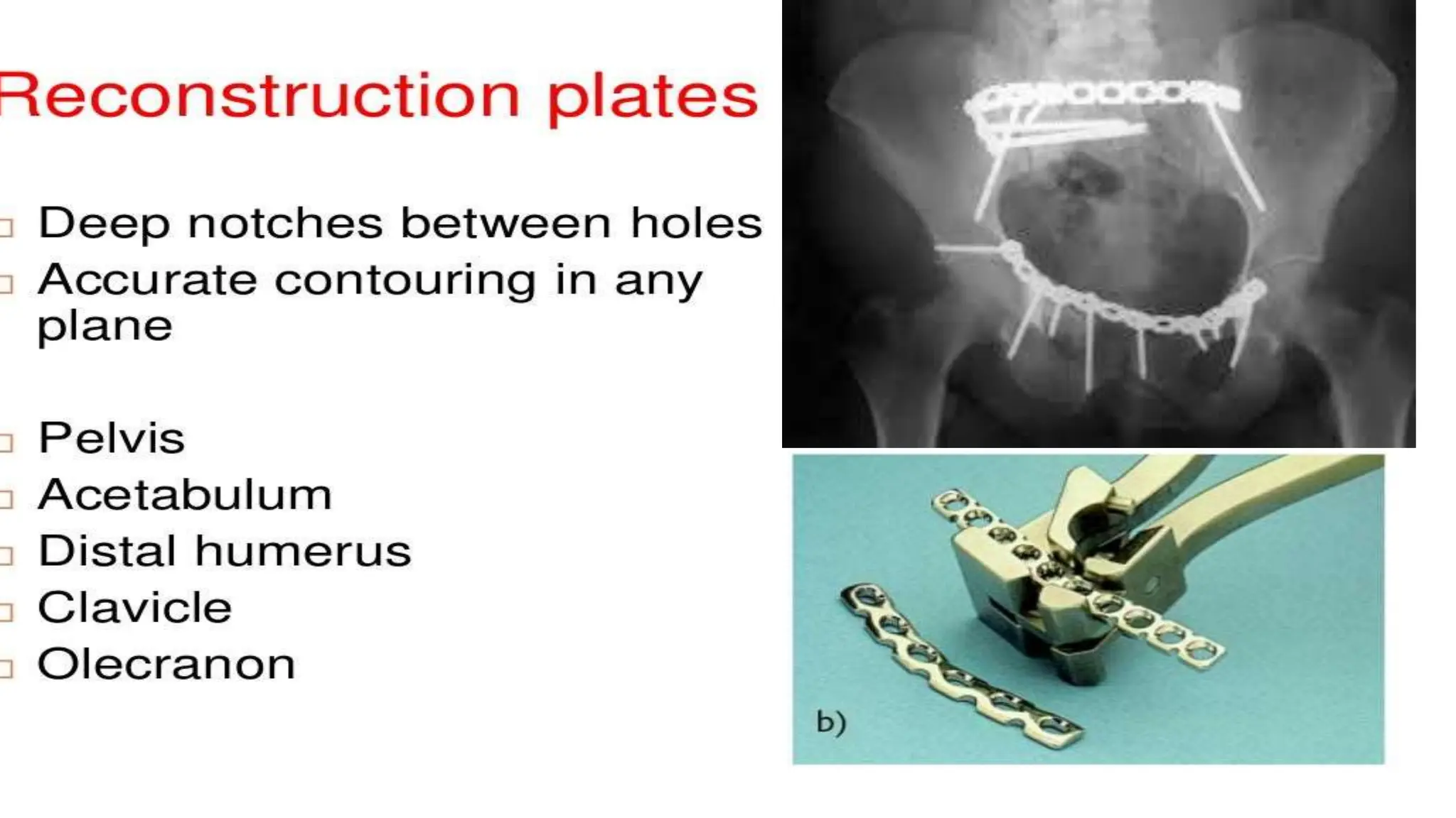 BONE PLATING USES AND COMPLICATION ORTHOPAEDICS PPT | PPTX