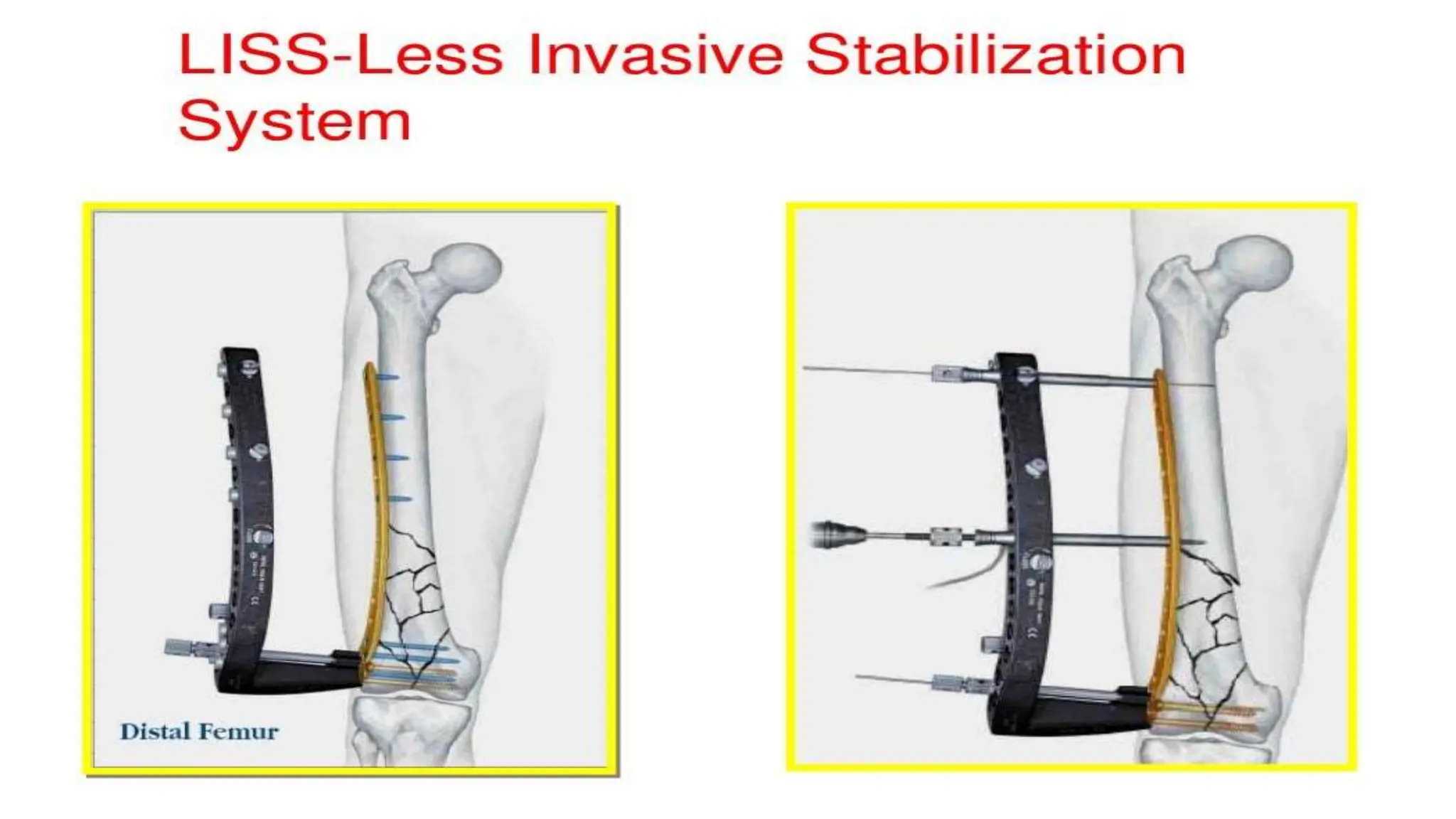 BONE PLATING USES AND COMPLICATION ORTHOPAEDICS PPT | PPTX