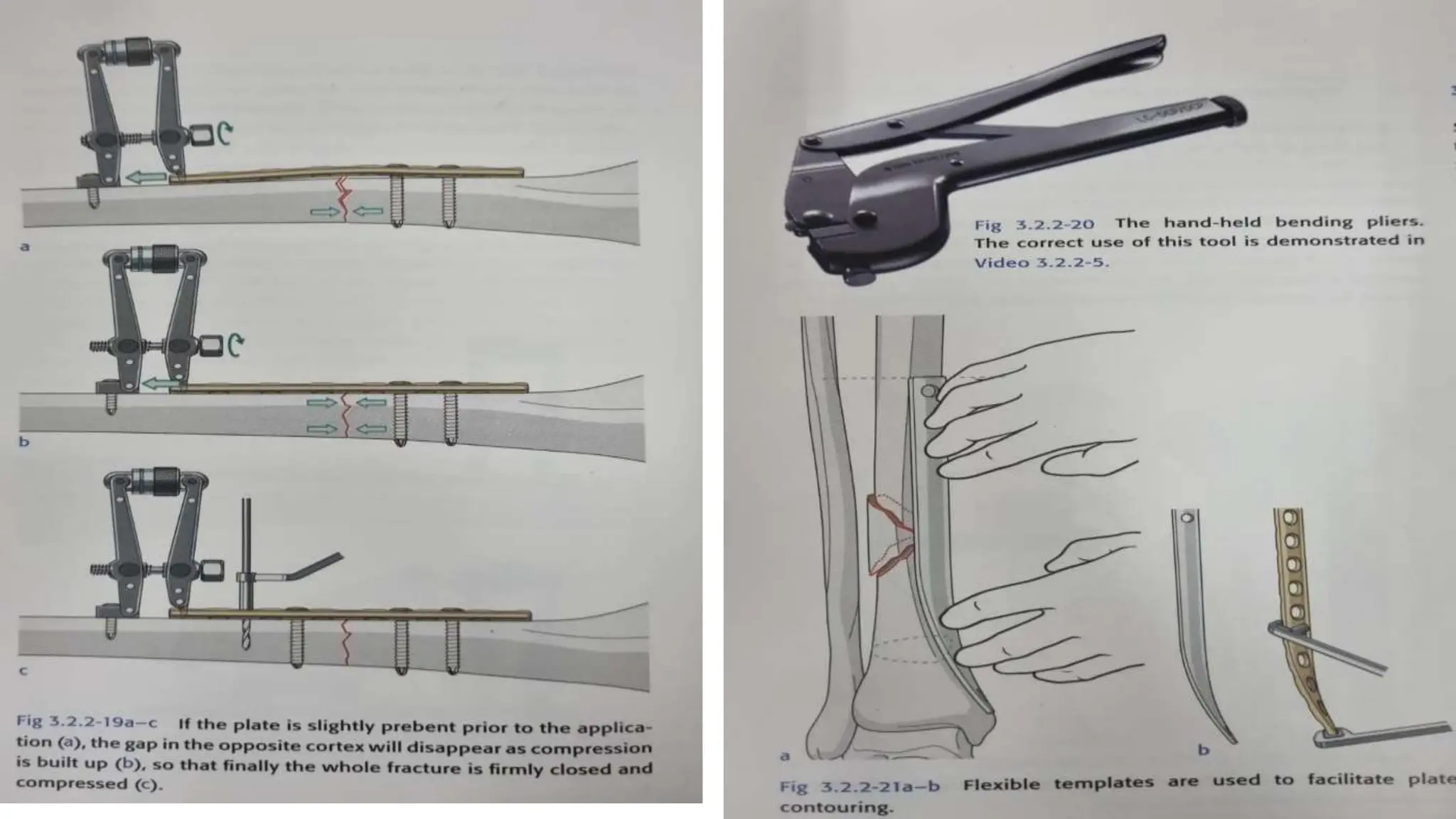 BONE PLATING USES AND COMPLICATION ORTHOPAEDICS PPT | PPTX
