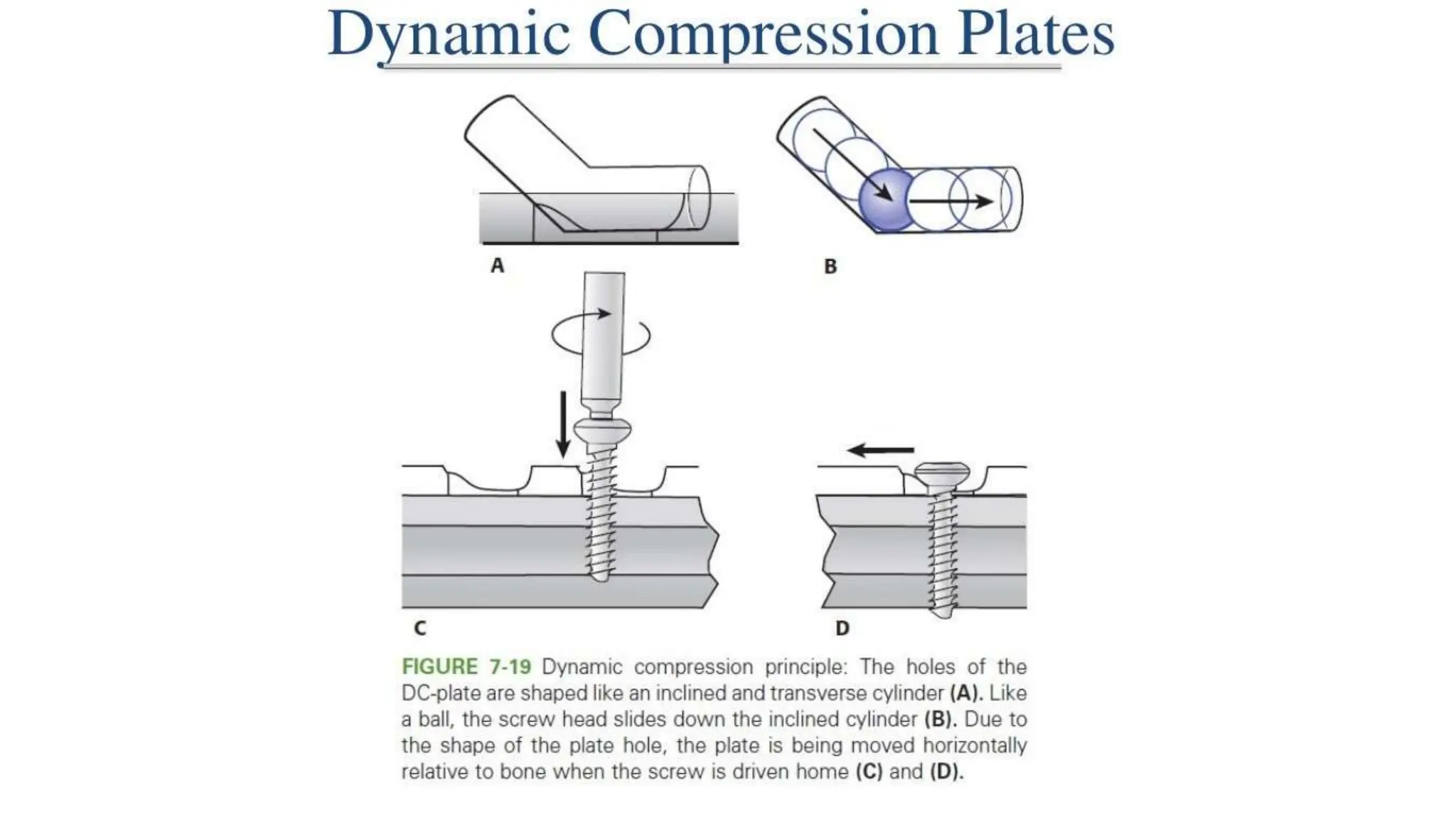 BONE PLATING USES AND COMPLICATION ORTHOPAEDICS PPT | PPTX