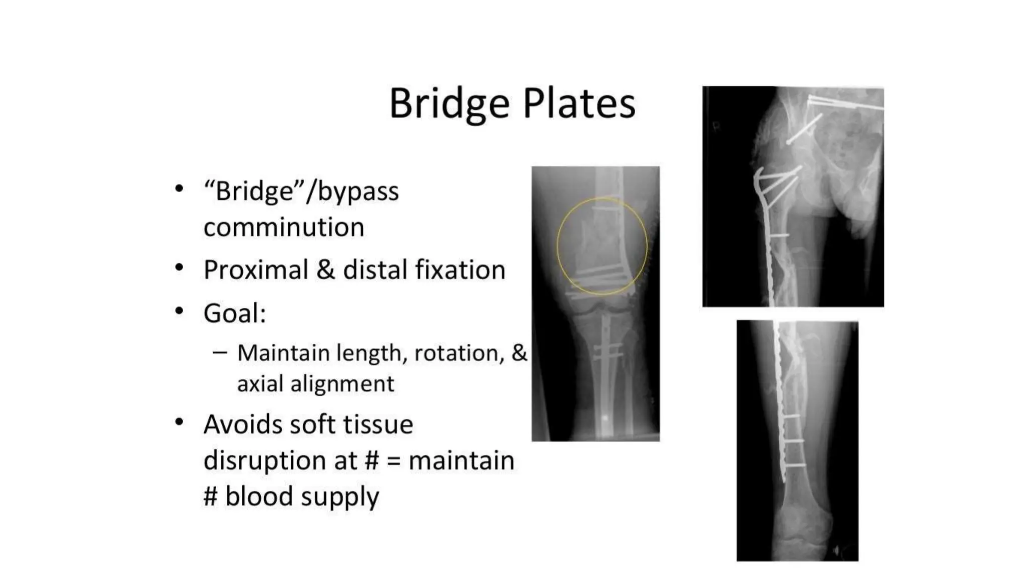 BONE PLATING USES AND COMPLICATION ORTHOPAEDICS PPT | PPTX