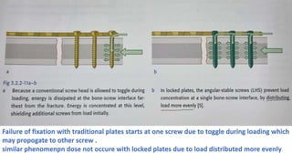 BONE PLATING USES AND COMPLICATION ORTHOPAEDICS PPT | PPTX