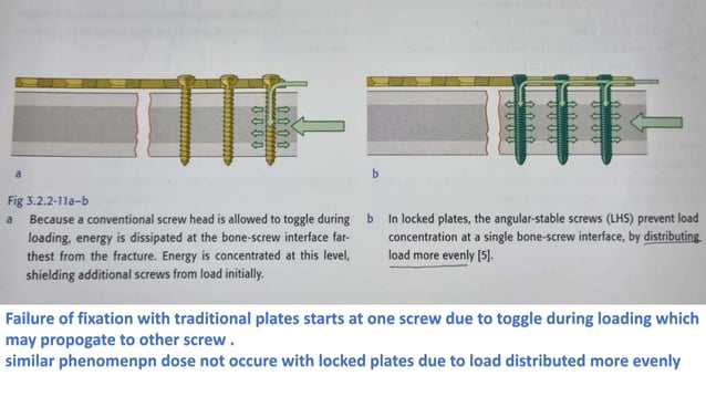 BONE PLATING USES AND COMPLICATION ORTHOPAEDICS PPT | PPTX | Death ...