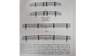 BONE PLATING USES AND COMPLICATION ORTHOPAEDICS PPT | PPTX