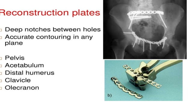 BONE PLATING USES AND COMPLICATION ORTHOPAEDICS PPT | PPTX | Death ...