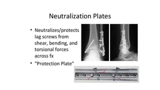 BONE PLATING USES AND COMPLICATION ORTHOPAEDICS PPT | PPTX