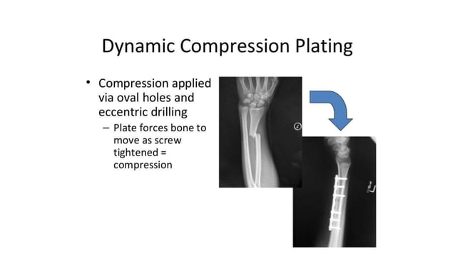 BONE PLATING USES AND COMPLICATION ORTHOPAEDICS PPT | PPTX | Death ...