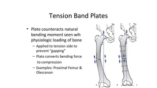 BONE PLATING USES AND COMPLICATION ORTHOPAEDICS PPT | PPTX