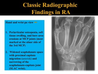 Radiological Interpretation of common bone Diseases | PPTX