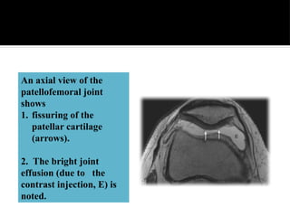 Radiological Interpretation of common bone Diseases | PPTX