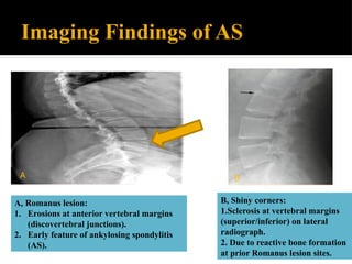 Radiological Interpretation of common bone Diseases | PPTX