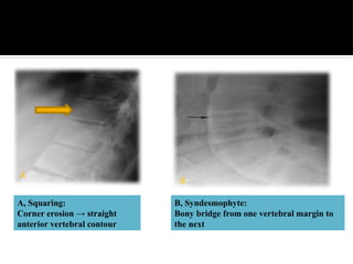 Radiological Interpretation of common bone Diseases | PPTX