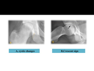 Radiological Interpretation of common bone Diseases | PPTX