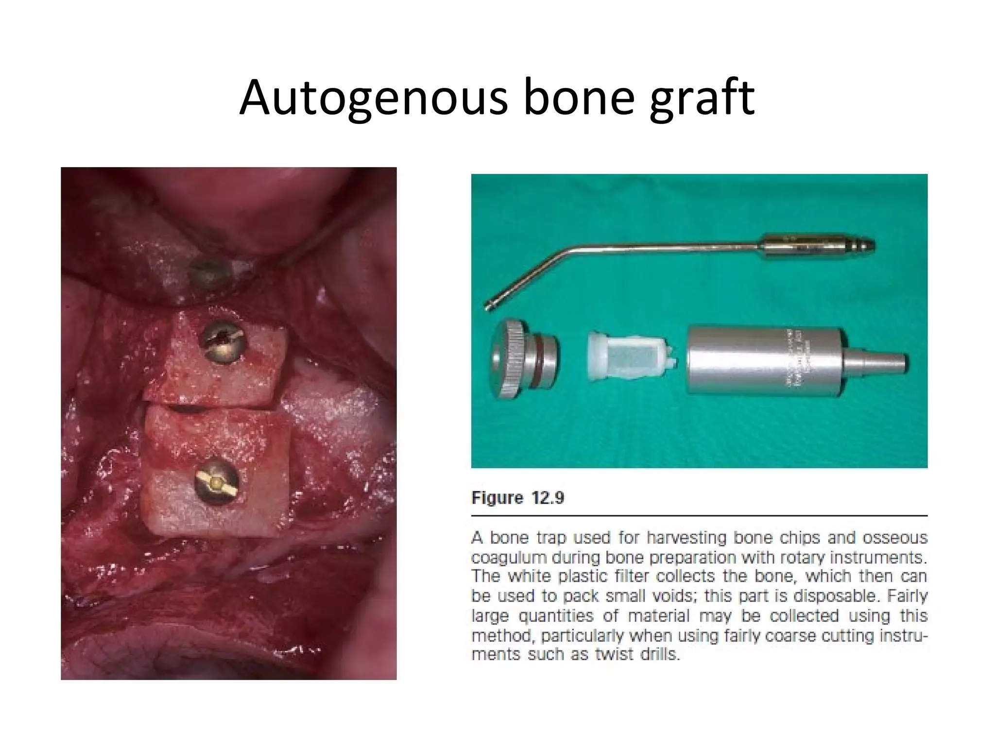 Bone regeneration and substitutes | PPT