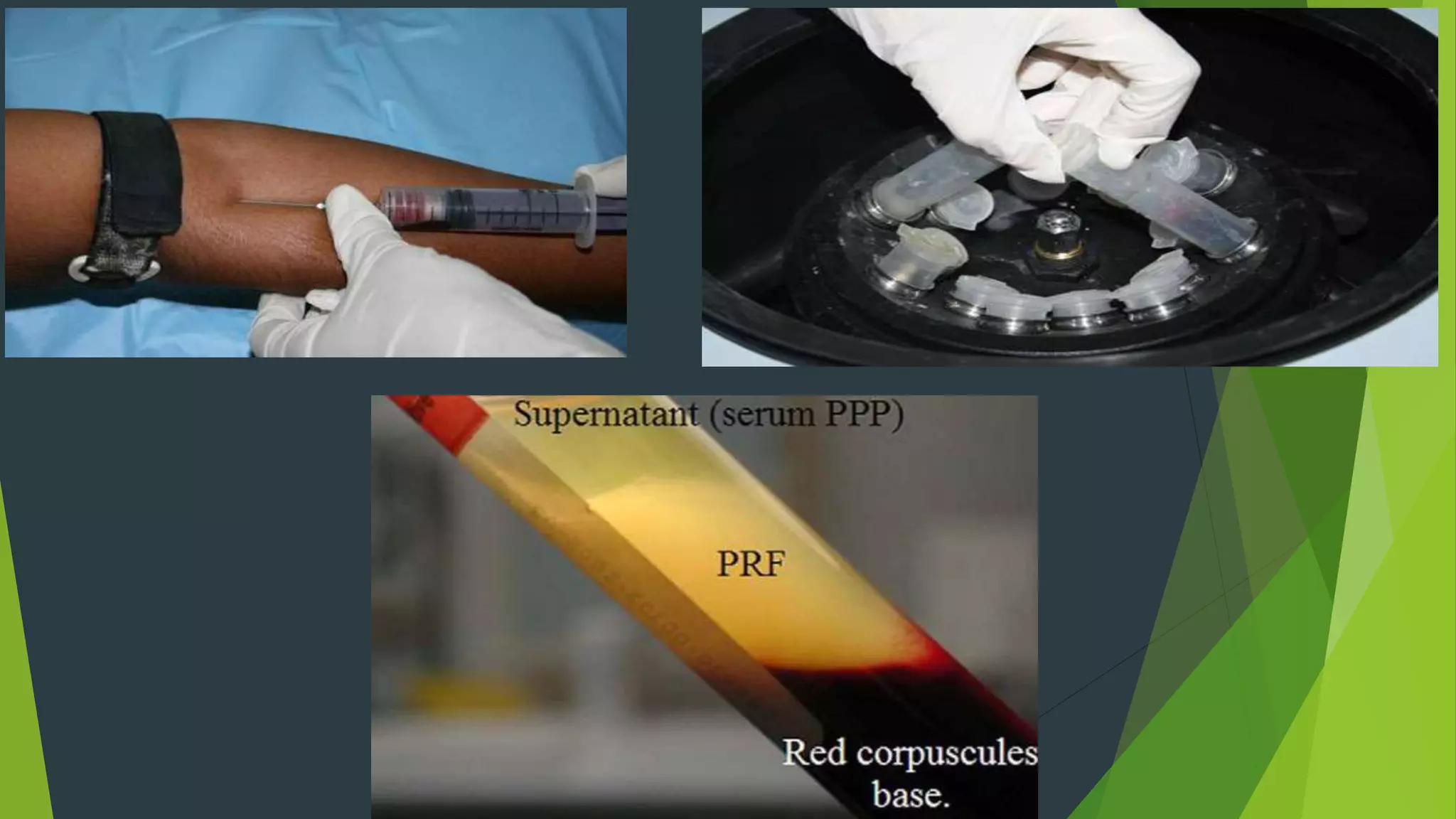 Bone regeneration in extraction sockets with autologous platelet | PPT