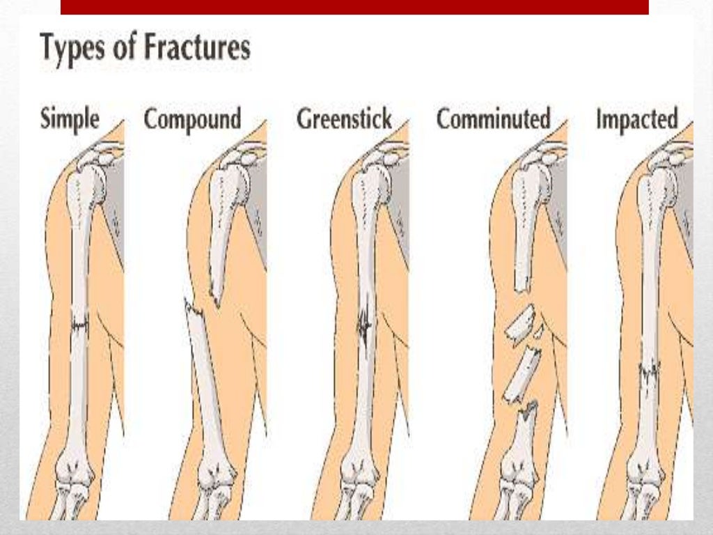 Types Of BONES Types Of BONES