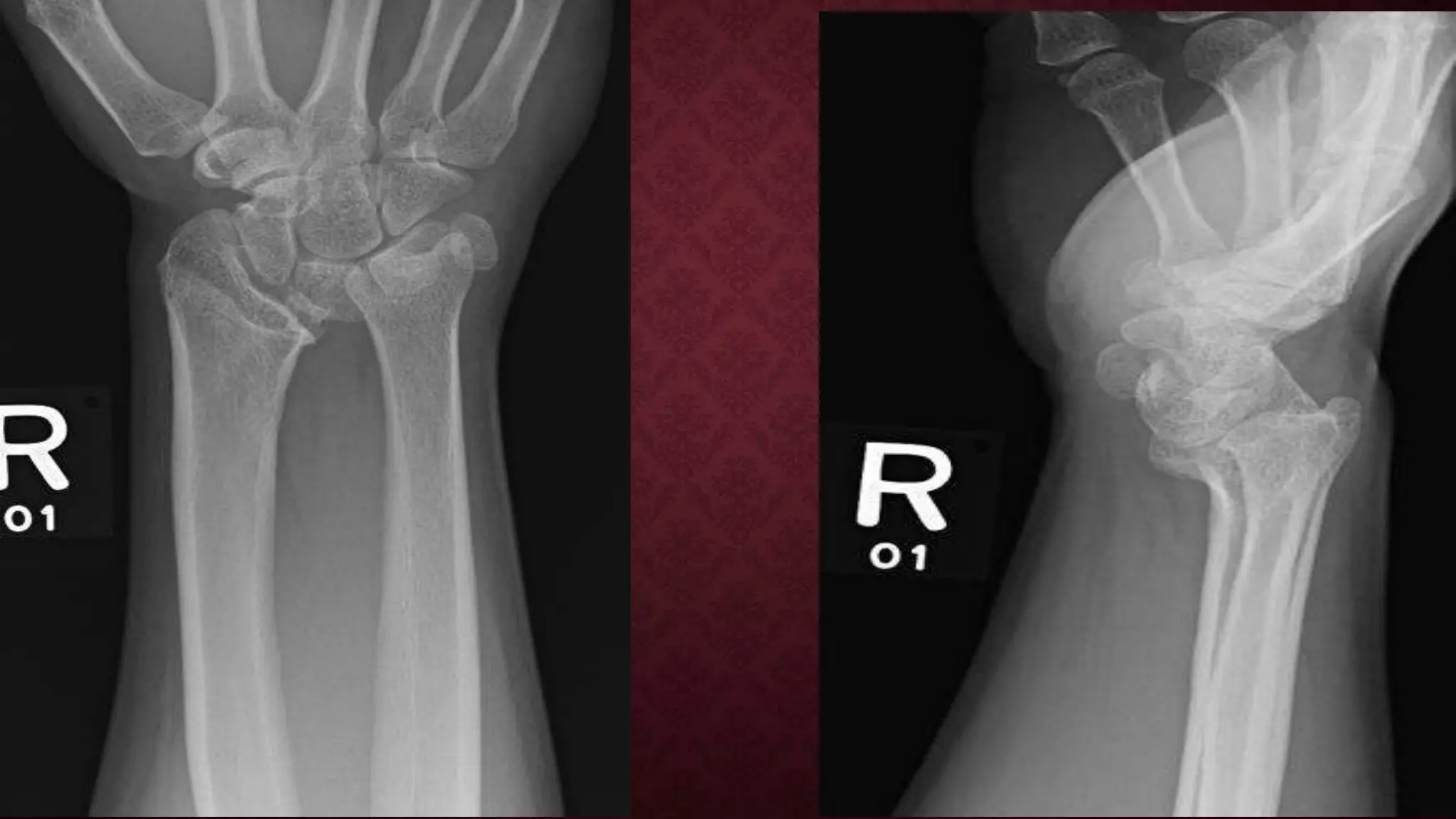 GIGANTISM,AND OTHER ENDOCRINE DISEASES OF BONE | PPTX
