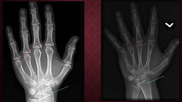 GIGANTISM,AND OTHER ENDOCRINE DISEASES OF BONE | PPT