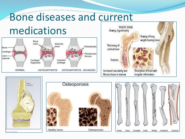 Bone targeting delivery system