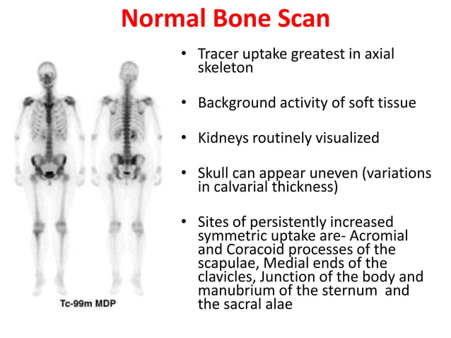 Bone scan in Orthopaedics | PPTX