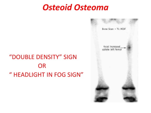 Bone scan in Orthopaedics | PPTX