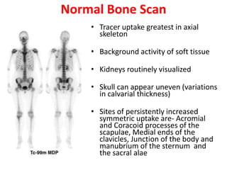 Abnormal Bone Scan