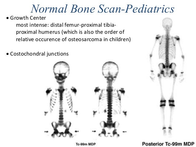 Bone scan in Orthopaedics