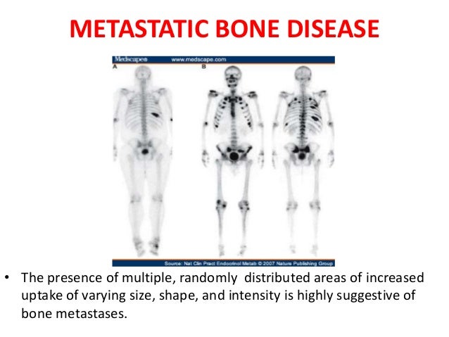 Bone scan in Orthopaedics