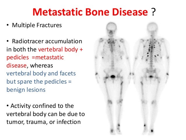 Bone scan in Orthopaedics