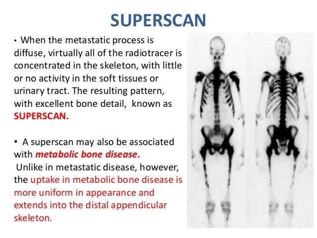 Bone scan in Orthopaedics