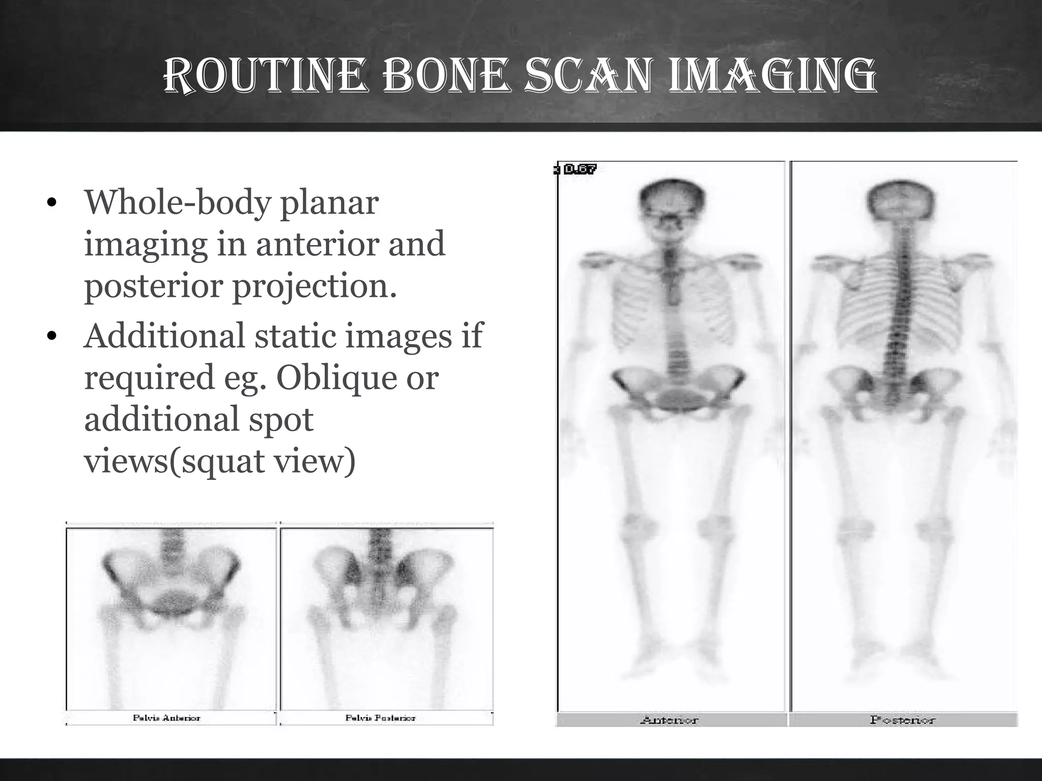 Bone scan | PPT