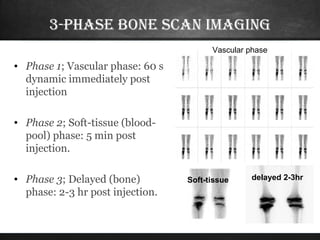 Bone scan | PPT