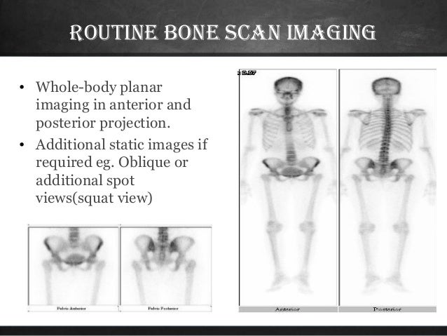 Bone scan