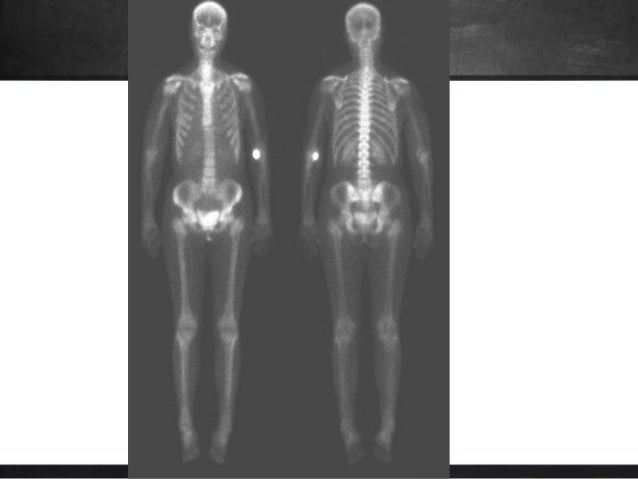 Bone scan