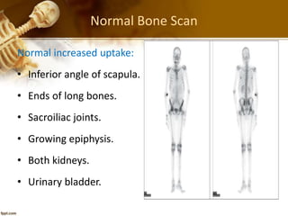 Bone Scan.pptxmmmmmmmmmmmmmmmmmmmmmmmmmmm | PPT