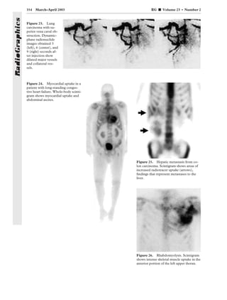 A detailed review of bone scintigraphy using Tc-99m, covering normal ...