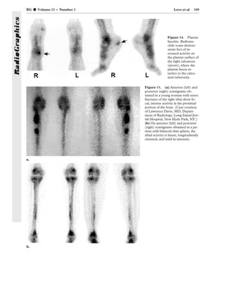 A detailed review of bone scintigraphy using Tc-99m, covering normal ...