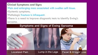 Bones Cancers- Ewing`s Sarcoma.pdf