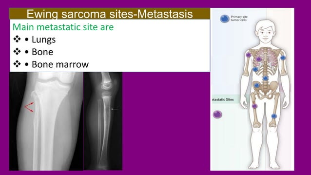 Bones Cancers- Ewing`s Sarcoma.pdf
