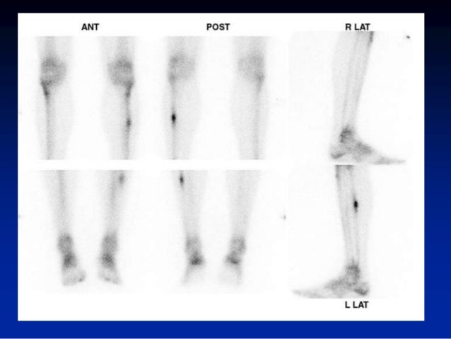 Bone Scan