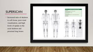 Bone Scan in Metabolic Disease, Infection, and Trauma | PPT