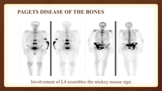 BONE SCINTIGRAPHY.pptx