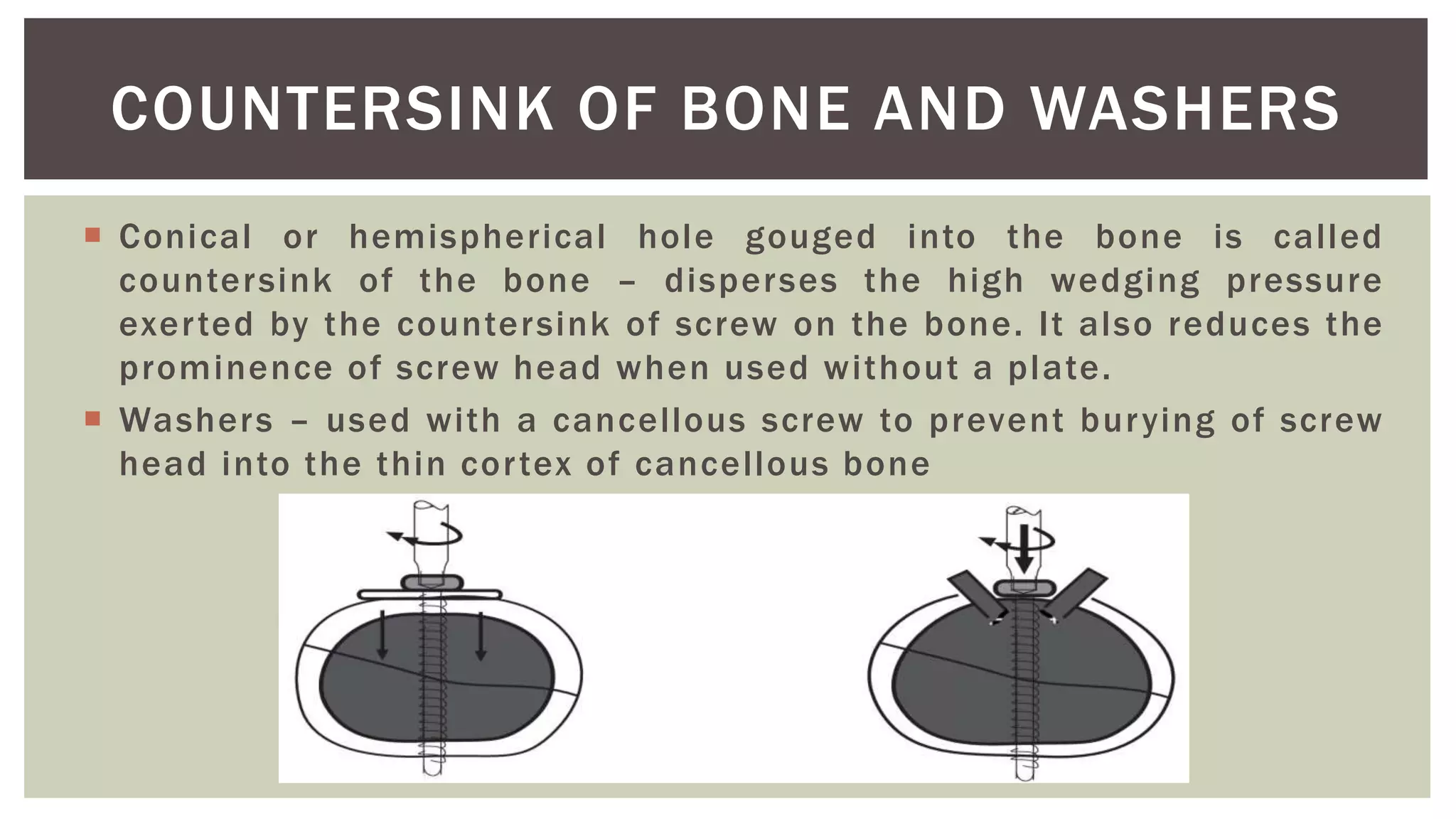 Bone screws - Principles and biomechanics - Dr. Sachin M | PPTX