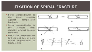 Bone screws - Principles and biomechanics - Dr. Sachin M | PPTX