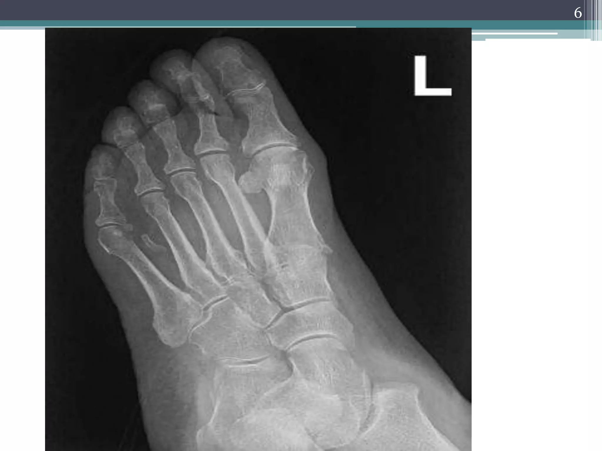 Bones,joints and soft tissue tumors | PPTX