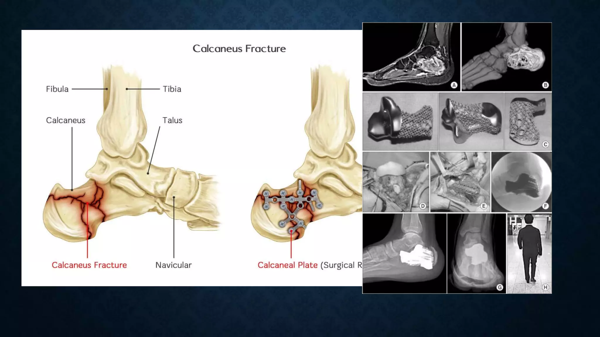 (Orthopedics) The mechanics of the bones of the feet (with notes in ...