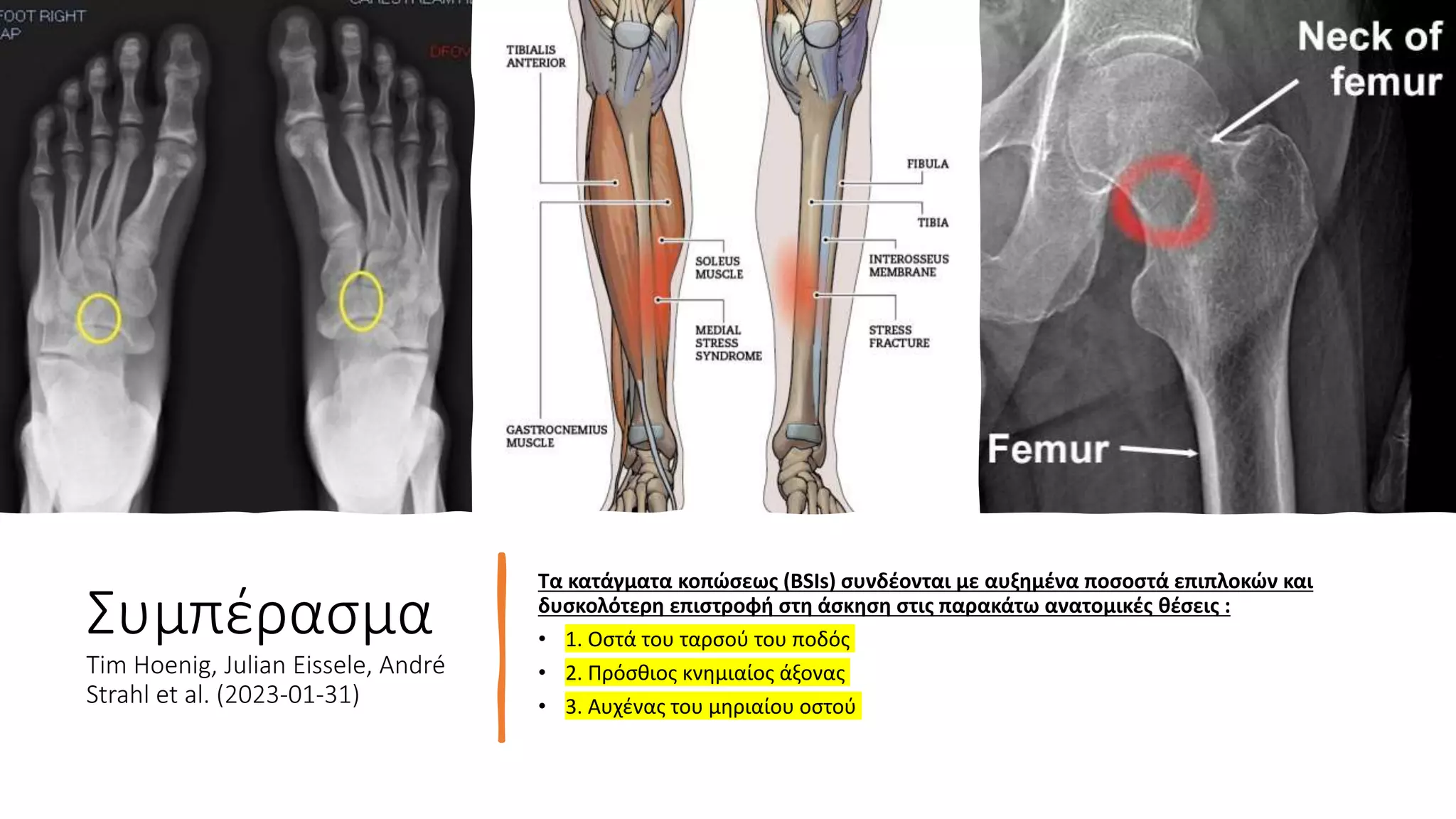 Bone Stress Injuries | PPTX