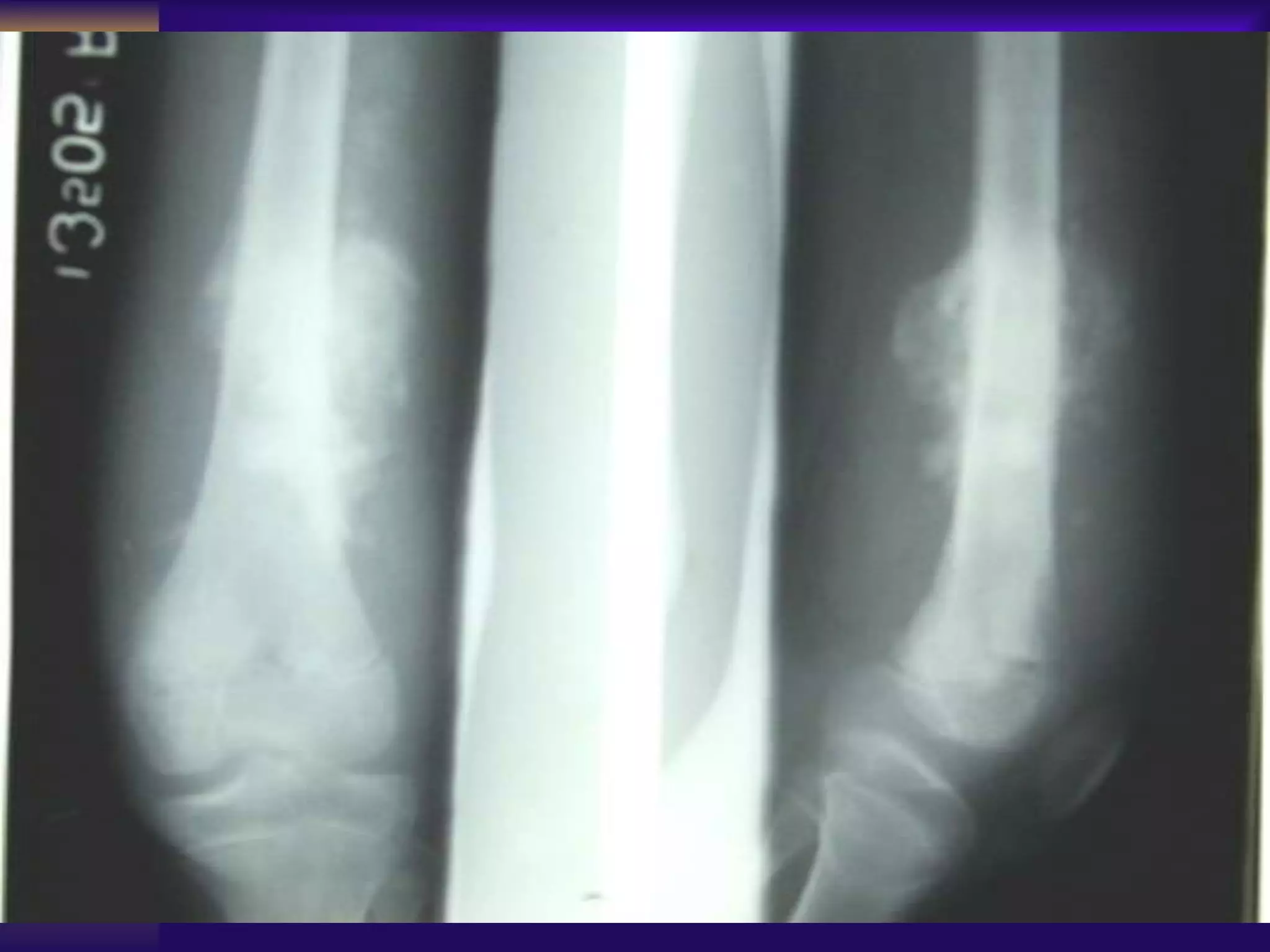 Bone tumor radiological approach | PPT