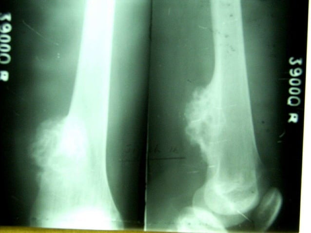 Bone tumor radiological approach | PPT | Bone and Joint Conditions ...